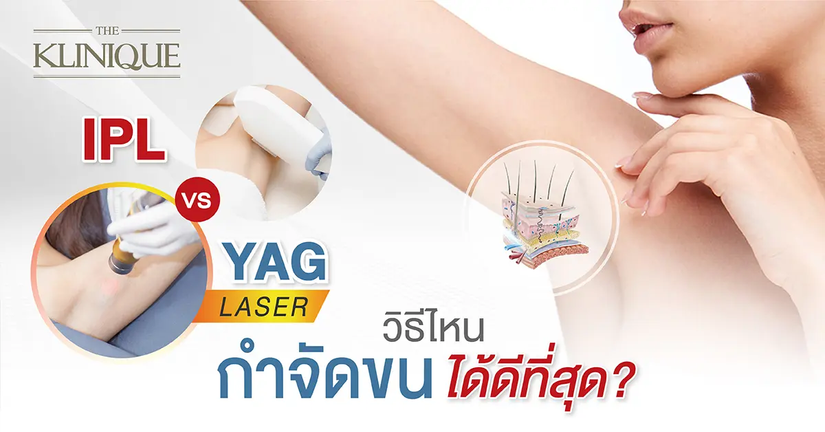 เลเซอร์ขนรักแร้ด้วย YAG กับ IPL แตกต่างกันอย่างไร – YAG 100% better than IPL? - theklinique