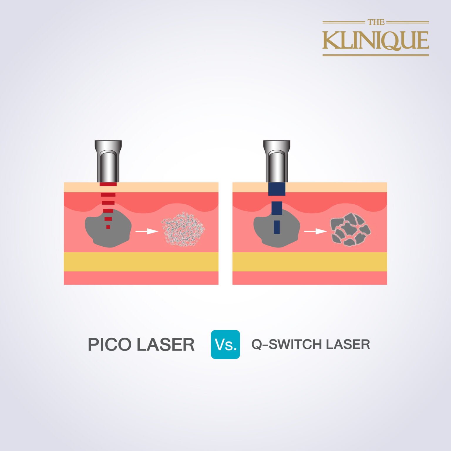 เลเซอร์หน้าใสด้วย PICO Clear Enlighten FX ต้องยิงหน้าแดงเลือดสาดไหม ...