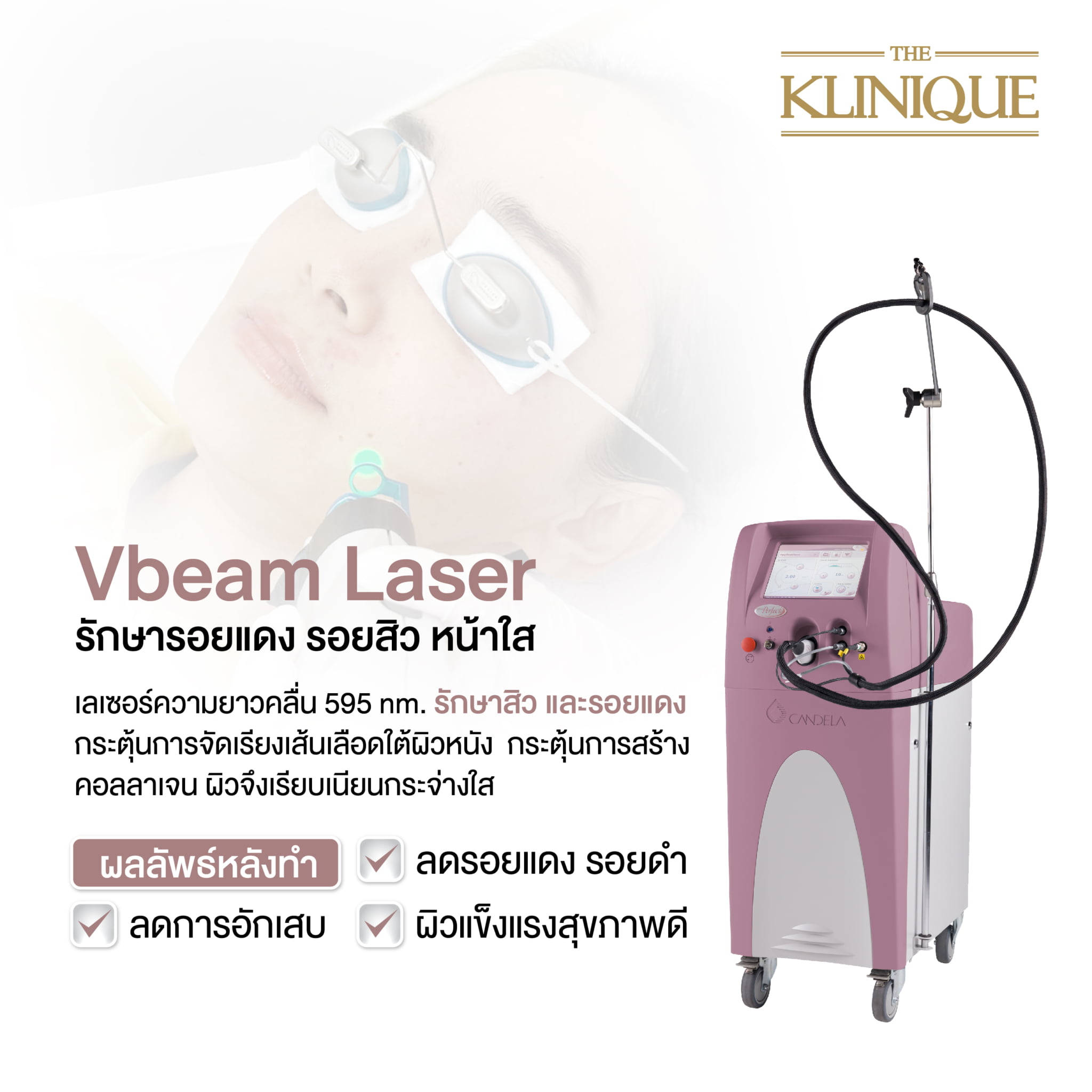 ลบรอยแดง VBeam Laser (วีบีม) เคลียร์รอยสิวผิวใสได้ดีที่สุด จริงหรือ ...