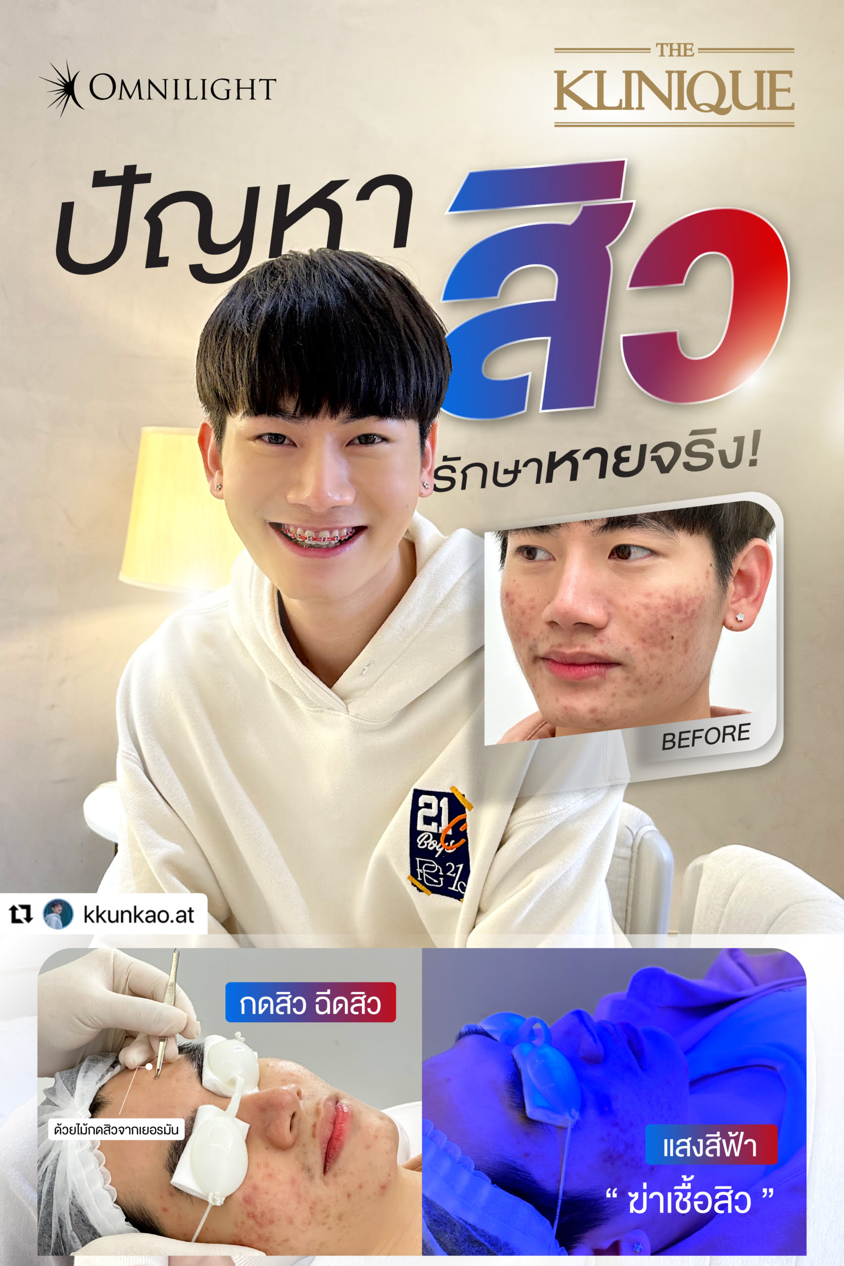 สิวอักเสบ นูน แดง ไม่มีหัว รักษายังไง? - theklinique