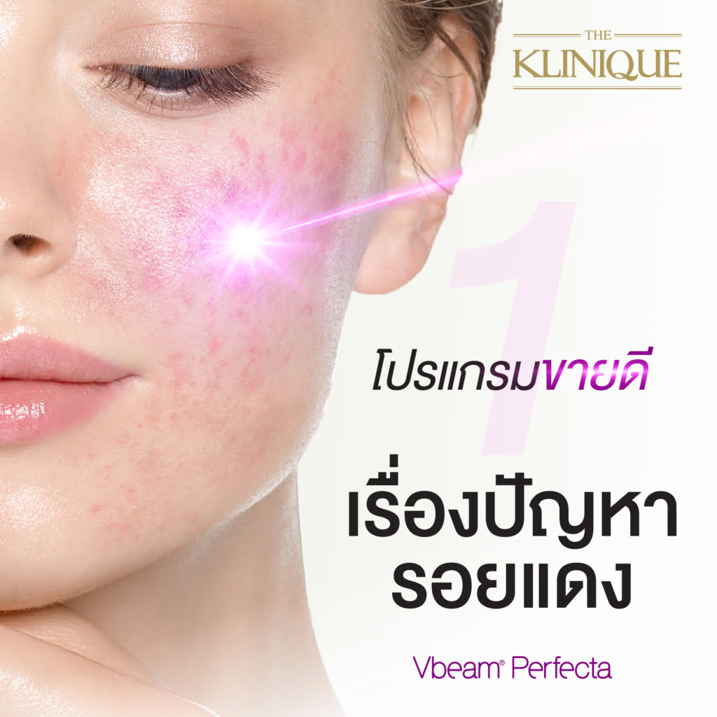 ลบรอยแดง VBeam Laser (วีบีม) เคลียร์รอยสิวผิวใสได้ดีที่สุด จริงหรือ ...