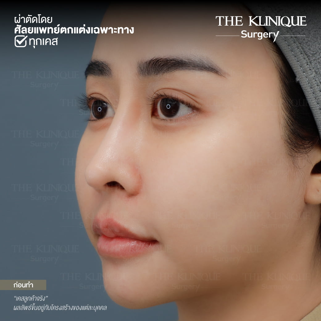 รีวิว เสริมจมูกโอเพ่น (Open) แก้จมูกที่ไหนดี? จมูกแข็ง ปลายแหลม เหมือนแม่มด - theklinique