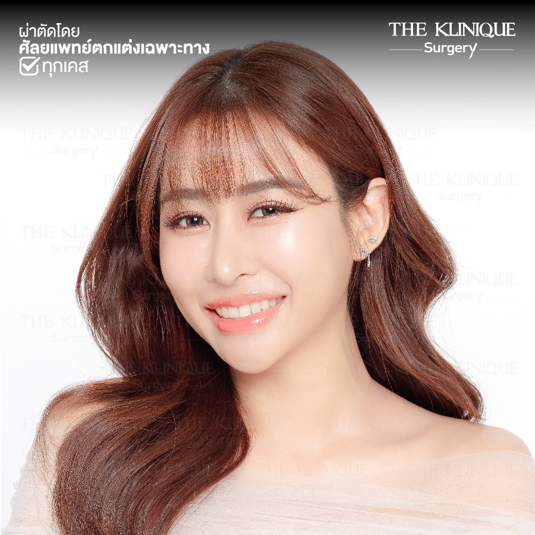 รวม รีวิวเสริมจมูกโอเพ่น (Open) ทรงจมูกเกาหลี By หมอคิม - theklinique