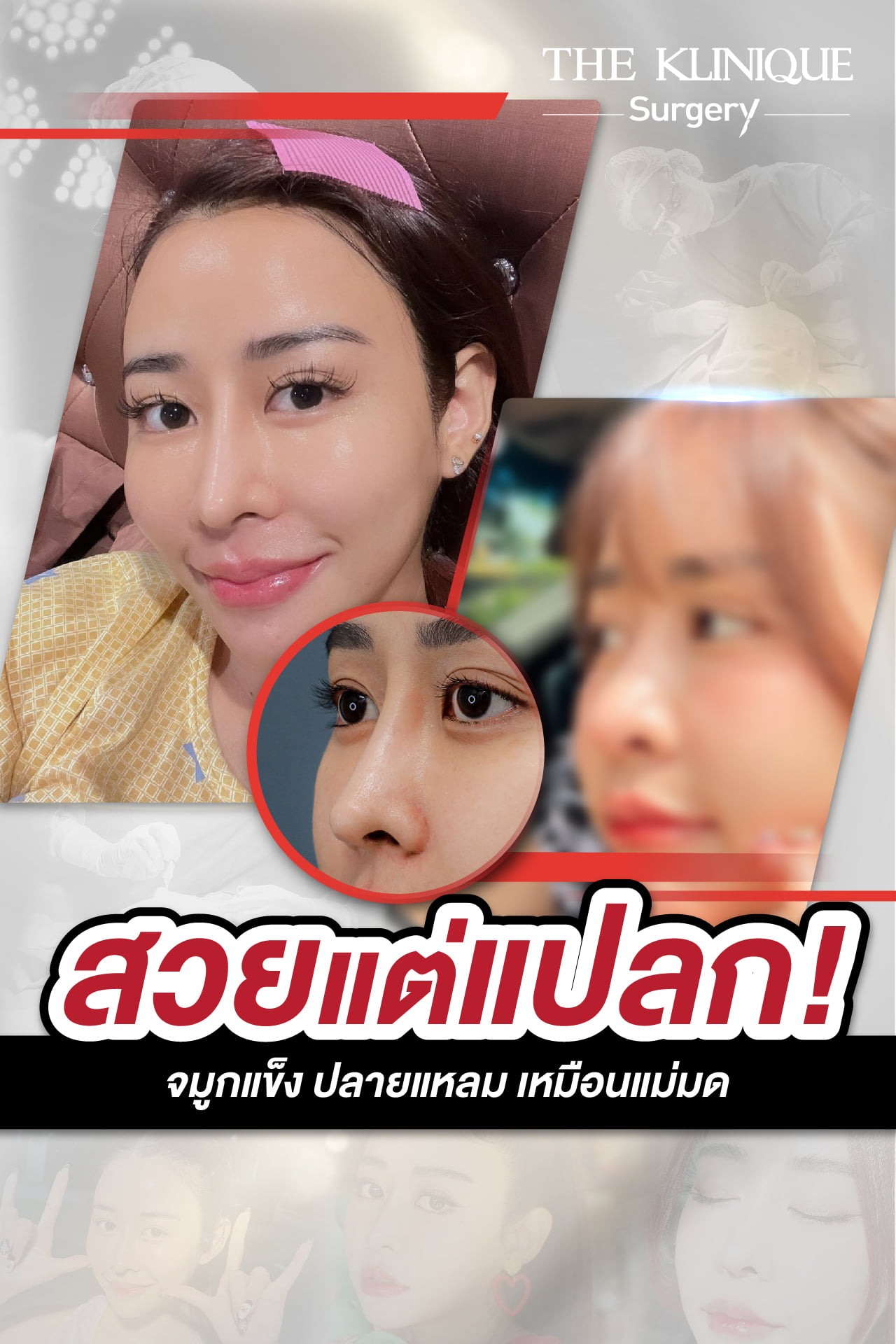 รีวิว เสริมจมูกโอเพ่น (Open) แก้จมูกที่ไหนดี? จมูกแข็ง ปลายแหลม เหมือนแม่มด - theklinique