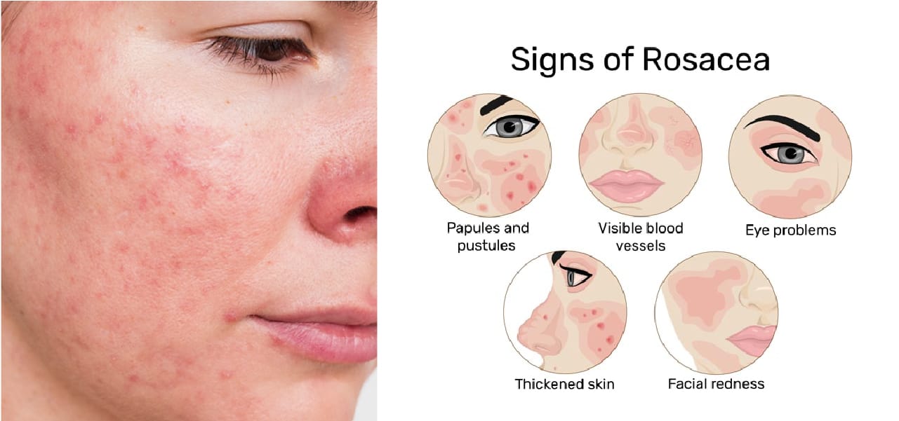 โรคผิวหนังอักเสบโรซาเชีย(Rosacea) หรือ สิวหน้าแดง คืออะไร รักษาอย่างไร? - theklinique