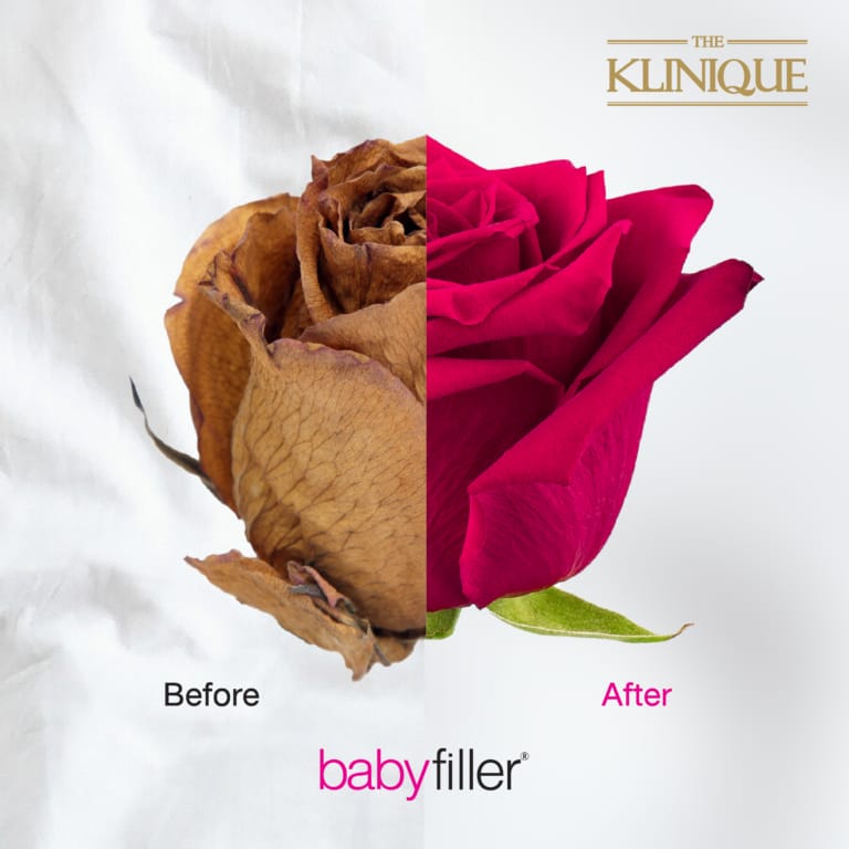 Baby Filler ฟิลเลอร์น้องสาว เติมเต็มน้องสาวให้ทรงสวย อิ่มฟู ดูเด็กอีก ...