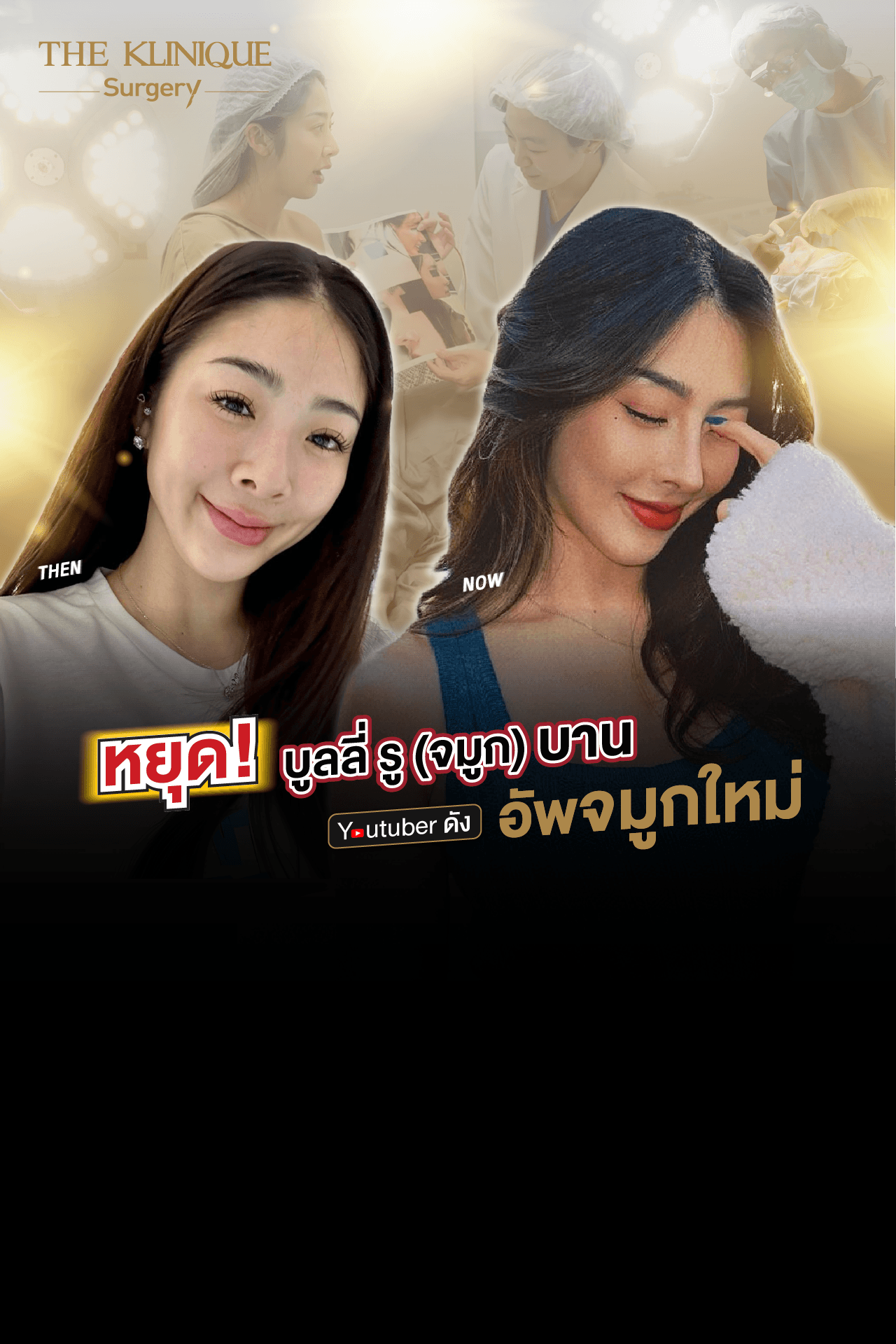 รีวิว เสริมจมูกโอเพ่น(Open) หยุด! บูลลี่ น้องแนน รูจมูกบาน - theklinique
