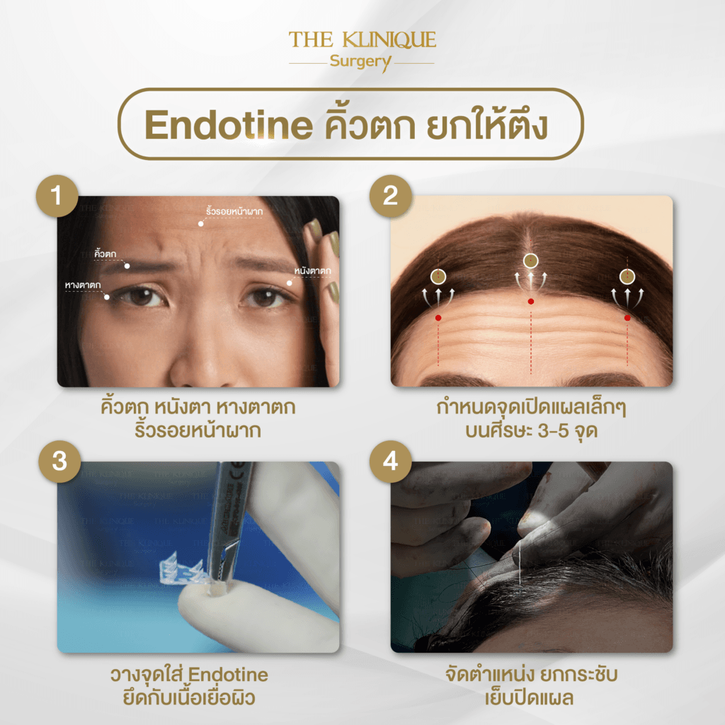 Endotine ยกระชับยกผิวหน้า แก้ปัญหาหน้าผากย่น คิ้วตก หางตาตก - theklinique