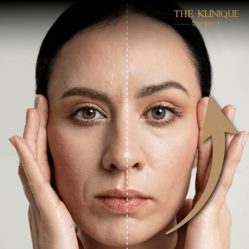 Endotine ยกระชับยกผิวหน้า แก้ปัญหาหน้าผากย่น คิ้วตก หางตาตก - theklinique