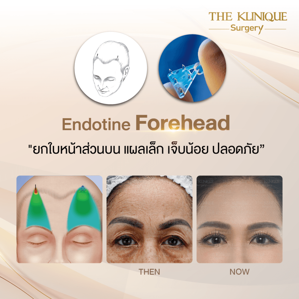 Endotine ยกระชับยกผิวหน้า แก้ปัญหาหน้าผากย่น คิ้วตก หางตาตก - theklinique