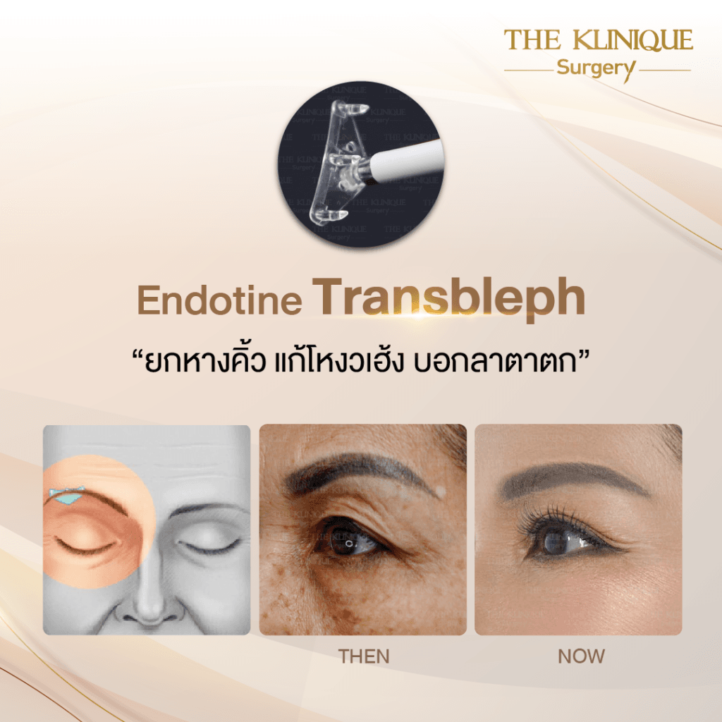 Endotine ยกระชับยกผิวหน้า แก้ปัญหาหน้าผากย่น คิ้วตก หางตาตก - theklinique
