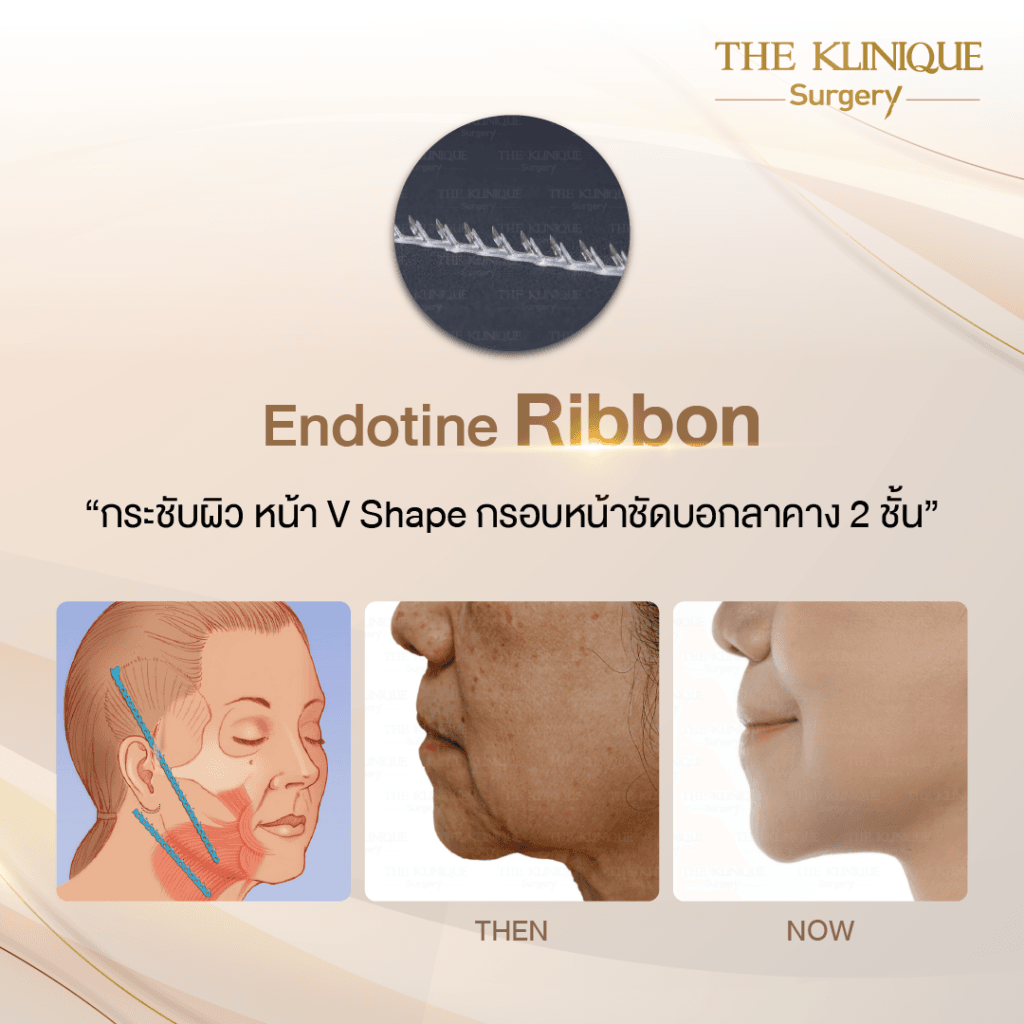 Endotine ยกระชับยกผิวหน้า แก้ปัญหาหน้าผากย่น คิ้วตก หางตาตก - theklinique