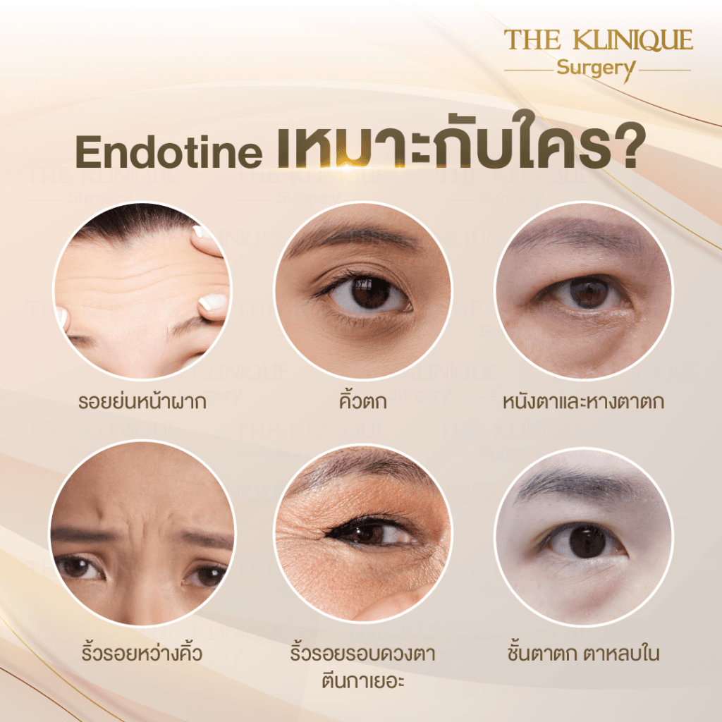 Endotine ยกระชับยกผิวหน้า แก้ปัญหาหน้าผากย่น คิ้วตก หางตาตก - theklinique