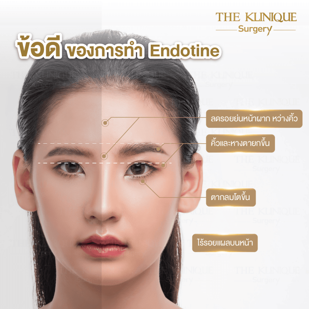 Endotine ยกระชับยกผิวหน้า แก้ปัญหาหน้าผากย่น คิ้วตก หางตาตก - theklinique