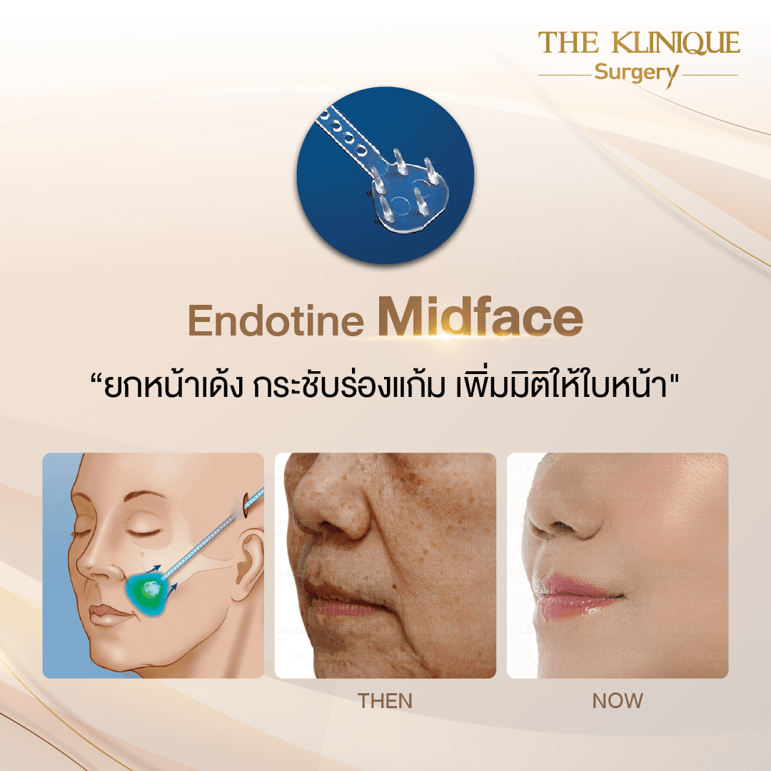 Endotine ยกระชับยกผิวหน้า แก้ปัญหาหน้าผากย่น คิ้วตก หางตาตก - theklinique