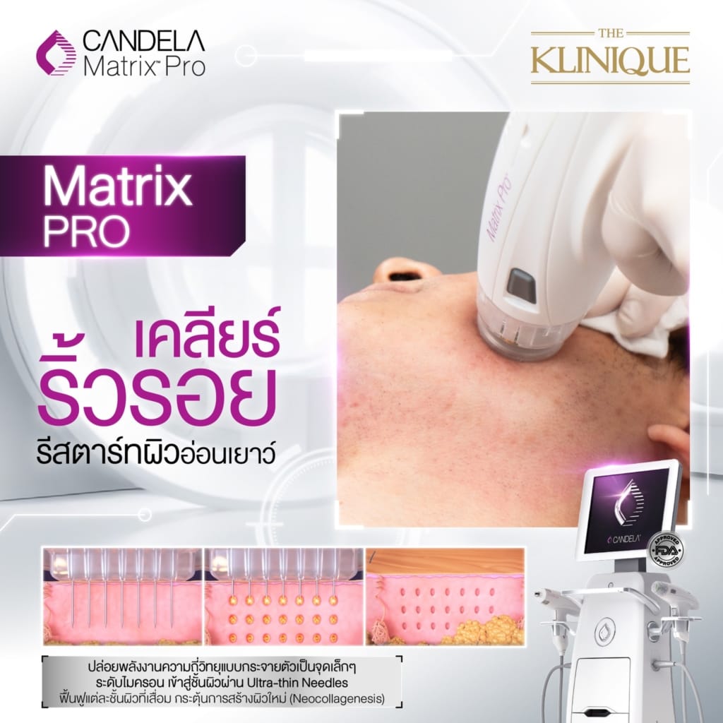 Candela Matrix PRO #เลเซอร์งานผิวAI ติดฟิลเตอร์ให้ผิวสวยกริบด้วย ...