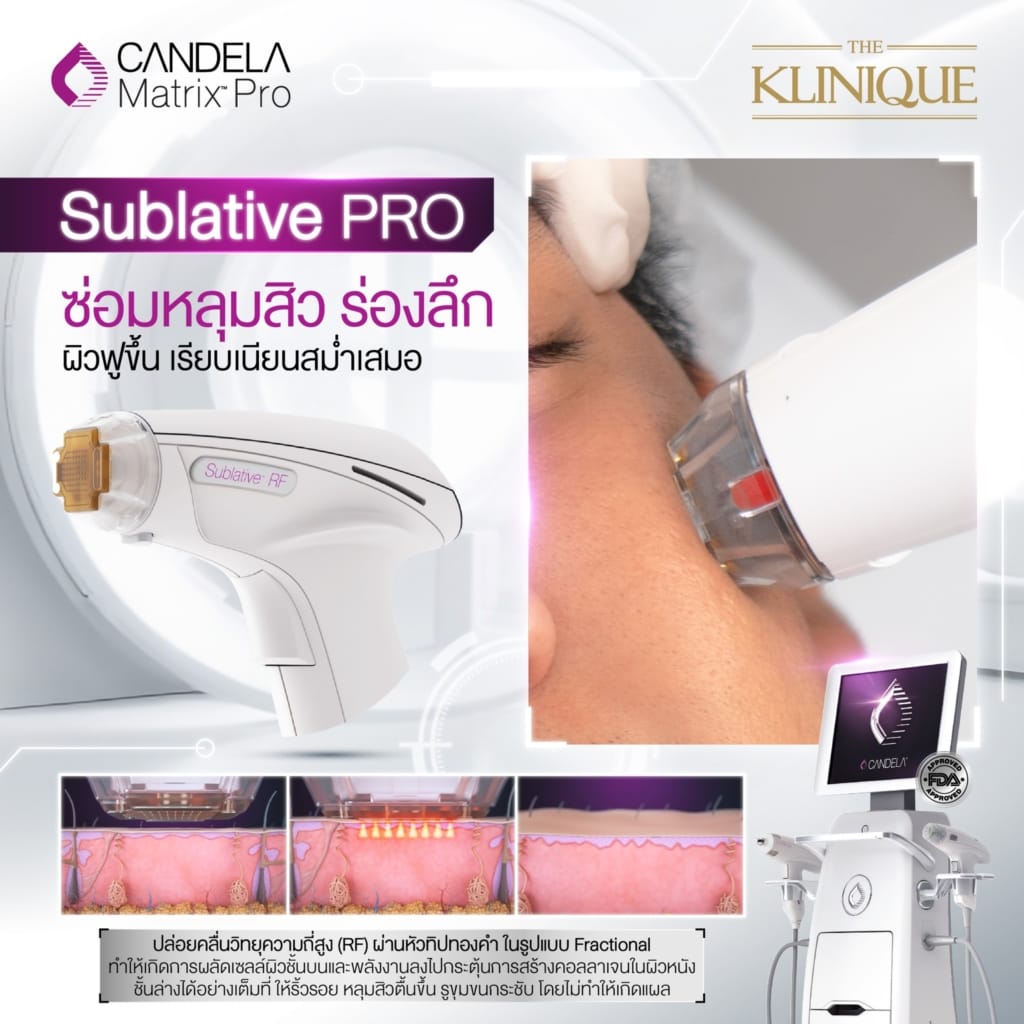 Candela Matrix PRO #เลเซอร์งานผิวAI ติดฟิลเตอร์ให้ผิวสวยกริบด้วย ...