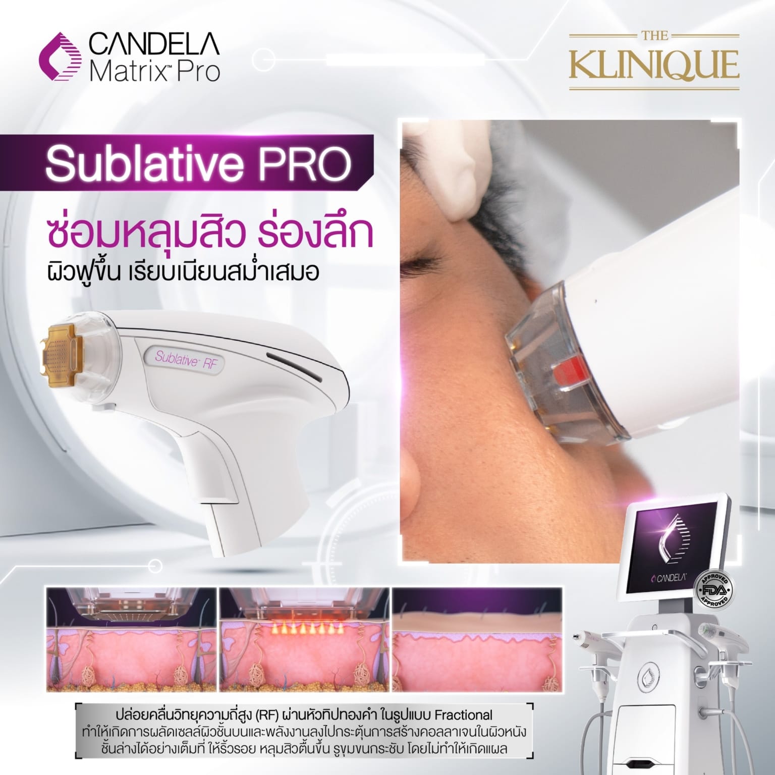 Candela Matrix PRO #เลเซอร์งานผิวAI ติดฟิลเตอร์ให้ผิวสวยกริบด้วย ...