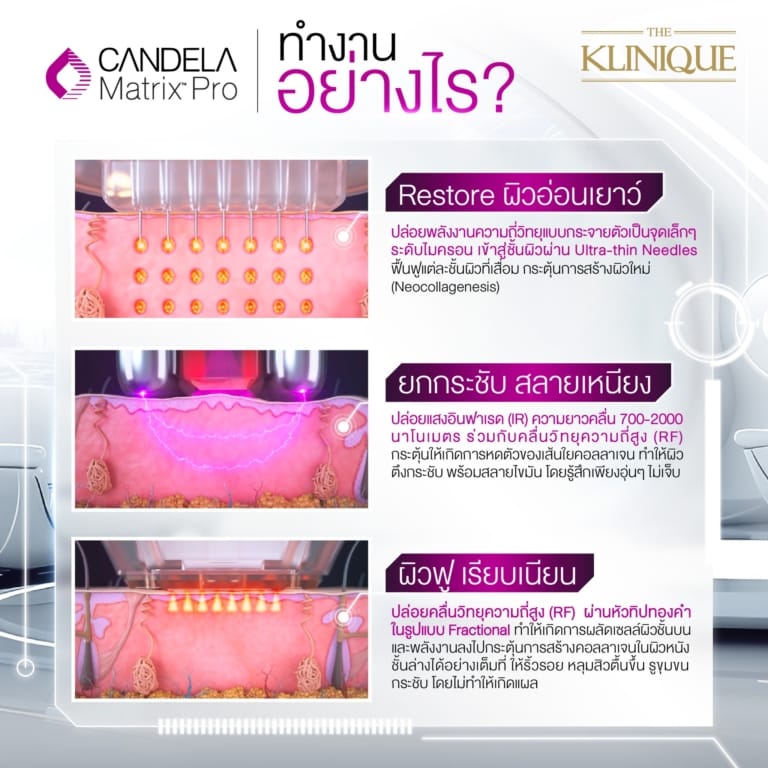 Candela Matrix PRO #เลเซอร์งานผิวAI ติดฟิลเตอร์ให้ผิวสวยกริบด้วย ...
