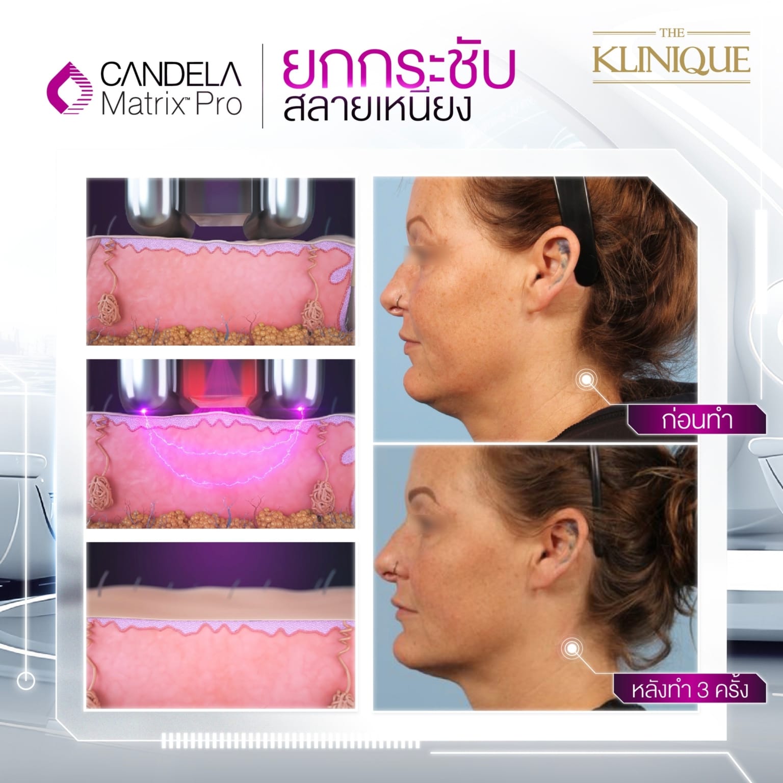 Candela Matrix PRO #เลเซอร์งานผิวAI ติดฟิลเตอร์ให้ผิวสวยกริบด้วย ...