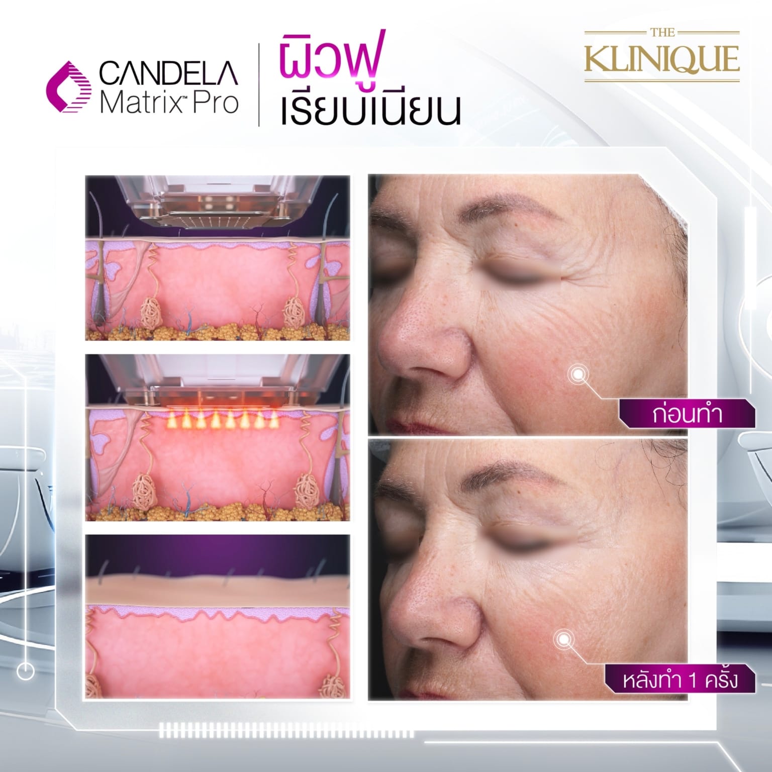 Candela Matrix PRO #เลเซอร์งานผิวAI ติดฟิลเตอร์ให้ผิวสวยกริบด้วย ...