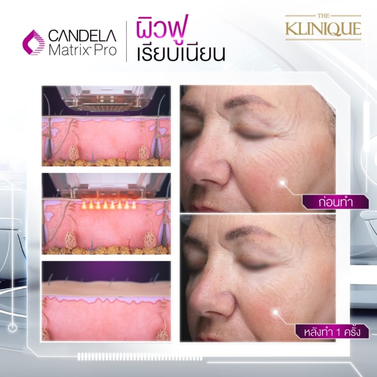 Candela Matrix PRO #เลเซอร์งานผิวAI ติดฟิลเตอร์ให้ผิวสวยกริบด้วย ...