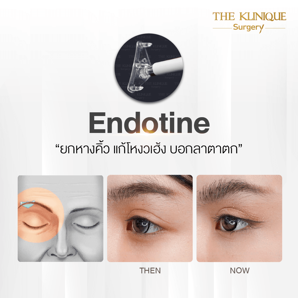 รีวิว ศัลยกรรมยกคิ้ว Endotine ยกหางตา + Foxy Eyes เปลี่ยนตาเศร้า เป็นตา ...