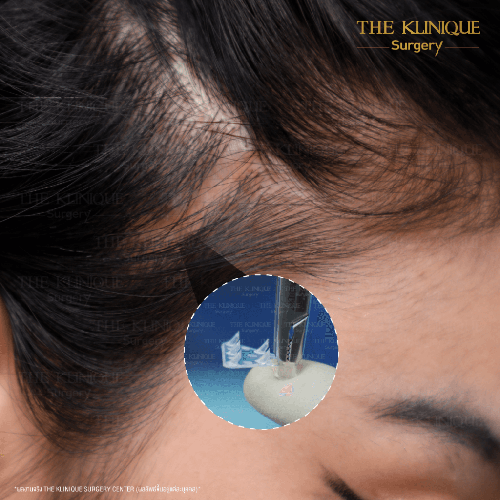 รีวิว ศัลยกรรมยกคิ้ว Endotine ยกหางตา + Foxy Eyes เปลี่ยนตาเศร้า เป็นตา ...