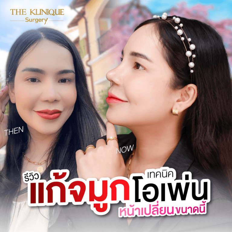 รีวิวเสริมจมูกOpen (โอเพ่น) แก้จมูก หน้าเปลี่ยน ดูเด็กลงสิบปี! - theklinique