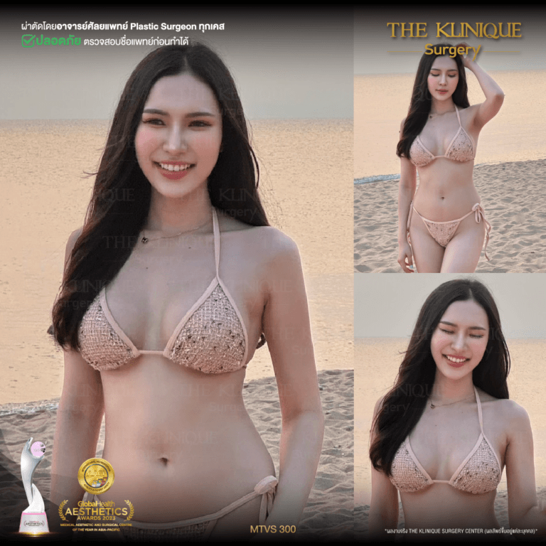 เสริมหน้าอก เลือกซิลิโคนแบบไหนดี Motiva หรือ Mentor - theklinique