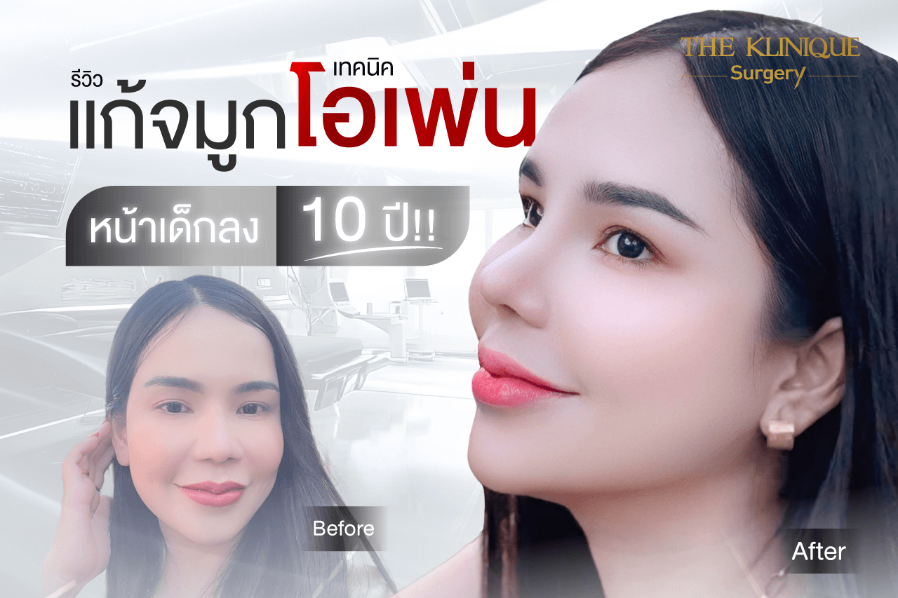 รีวิวเสริมจมูกOpen (โอเพ่น) แก้จมูก หน้าเปลี่ยน ดูเด็กลงสิบปี! - theklinique