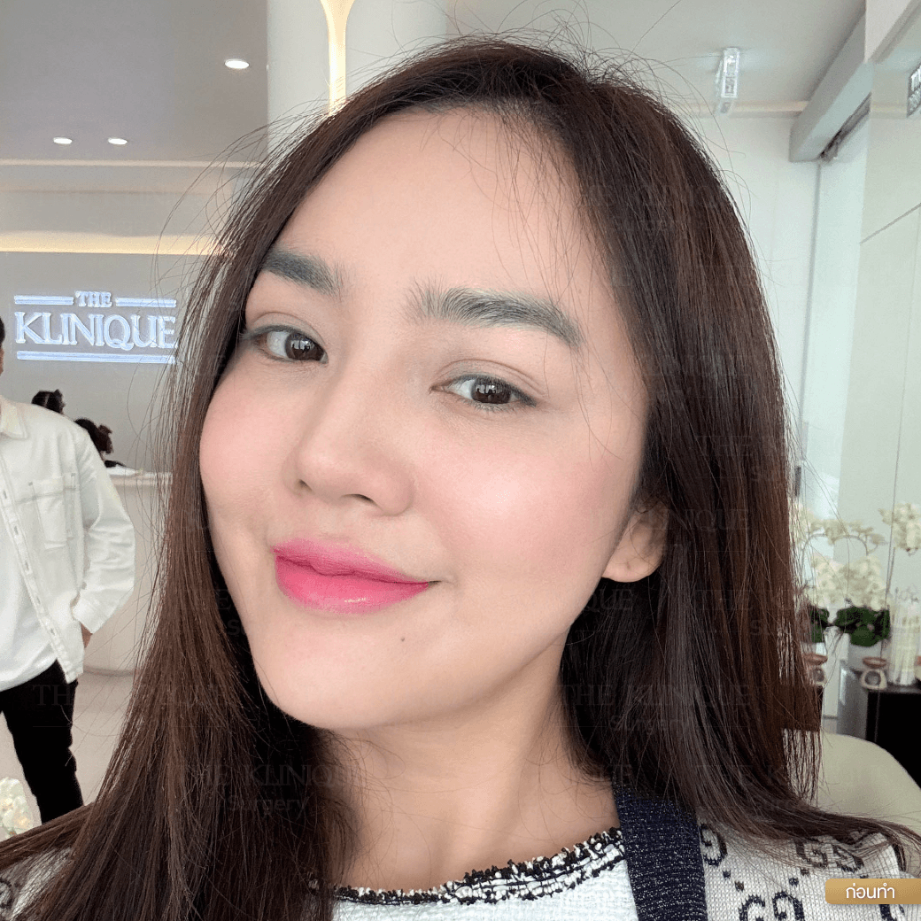 รีวิว เสริจมูกโอเพ่นแบบจัดเต็ม สอดอ เส้นด้าย ควักเงินแสน แก้จมูกใหม่ - theklinique