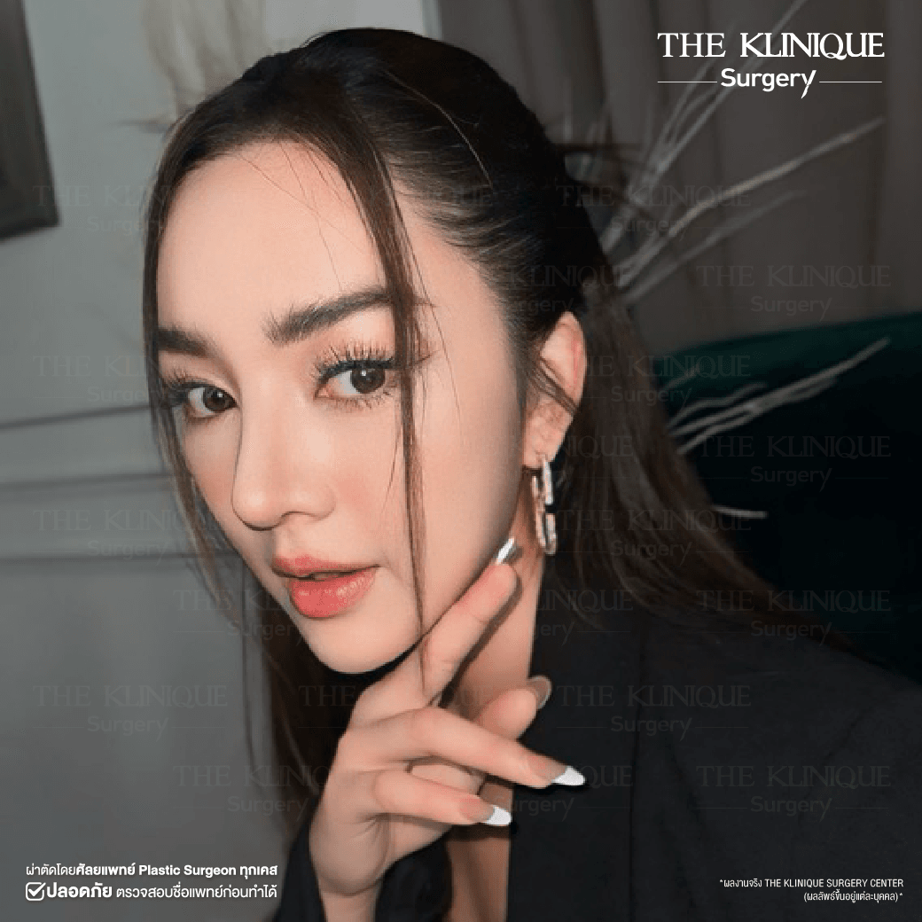 รีวิว เสริจมูกโอเพ่นแบบจัดเต็ม สอดอ เส้นด้าย ควักเงินแสน แก้จมูกใหม่ - theklinique