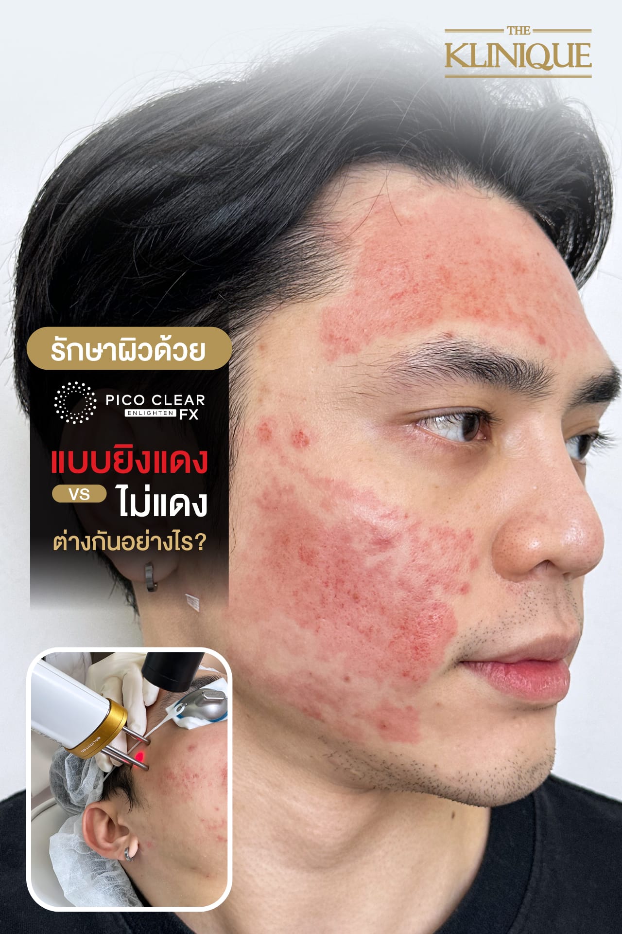 เลเซอร์หน้าใสด้วย PICO Clear Enlighten FX ต้องยิงหน้าแดงเลือดสาดไหม ...