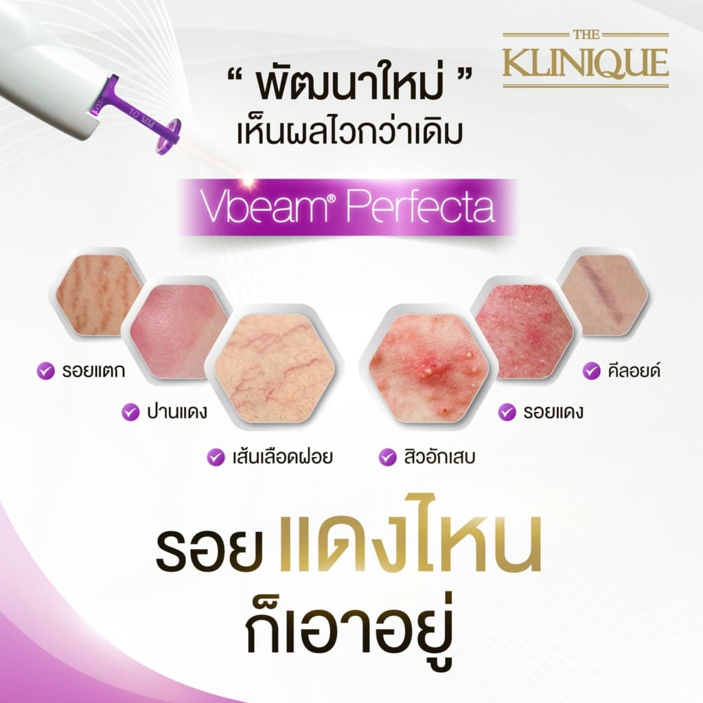 ลบรอยแดง VBeam Laser (วีบีม) เคลียร์รอยสิวผิวใสได้ดีที่สุด จริงหรือ ...
