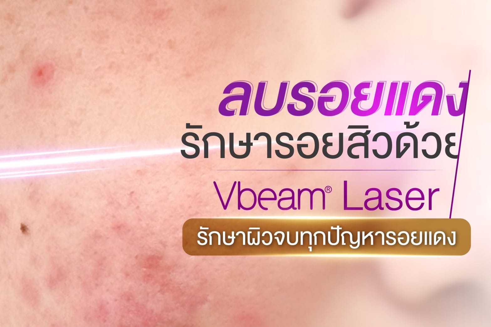 ลบรอยแดง รักษารอยสิวด้วย V beam Laser นวัตกรรมเลเซอร์รักษาผิวจบทุกปัญหา ...