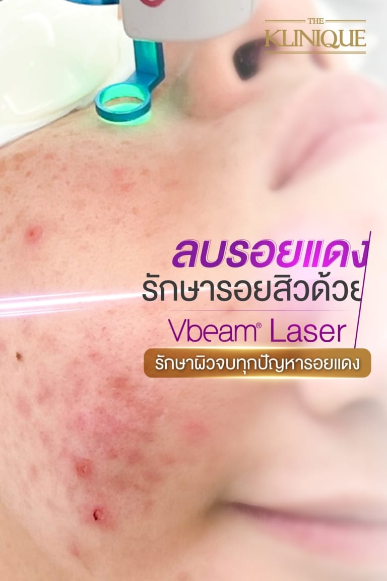 ลบรอยแดง รักษารอยสิวด้วย V beam Laser นวัตกรรมเลเซอร์รักษาผิวจบทุกปัญหา ...
