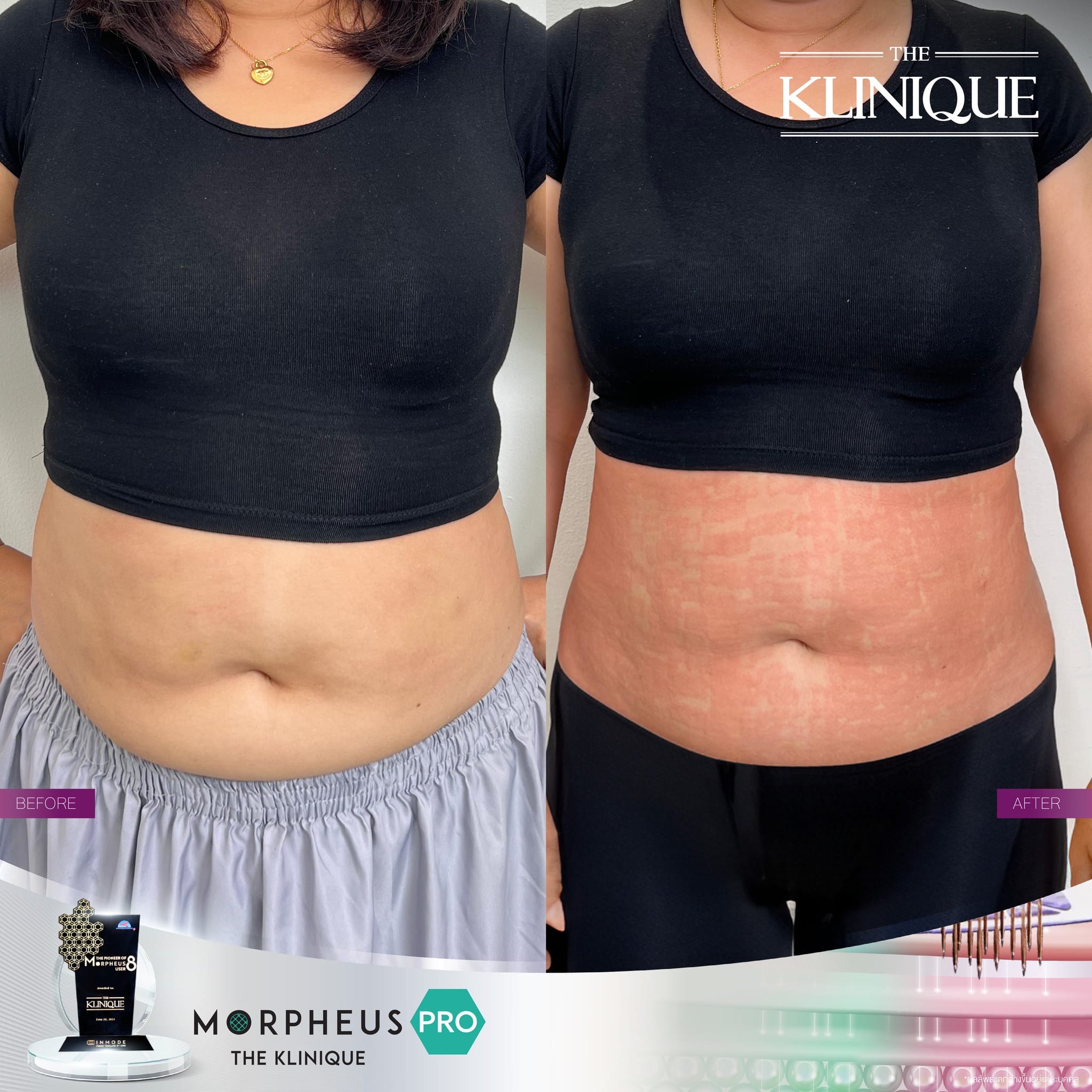 Morpheus PRO Body จบปัญหาผิวยับ กระชับหุ่นย้วย เคลียร์ผิวแตกลาย ...