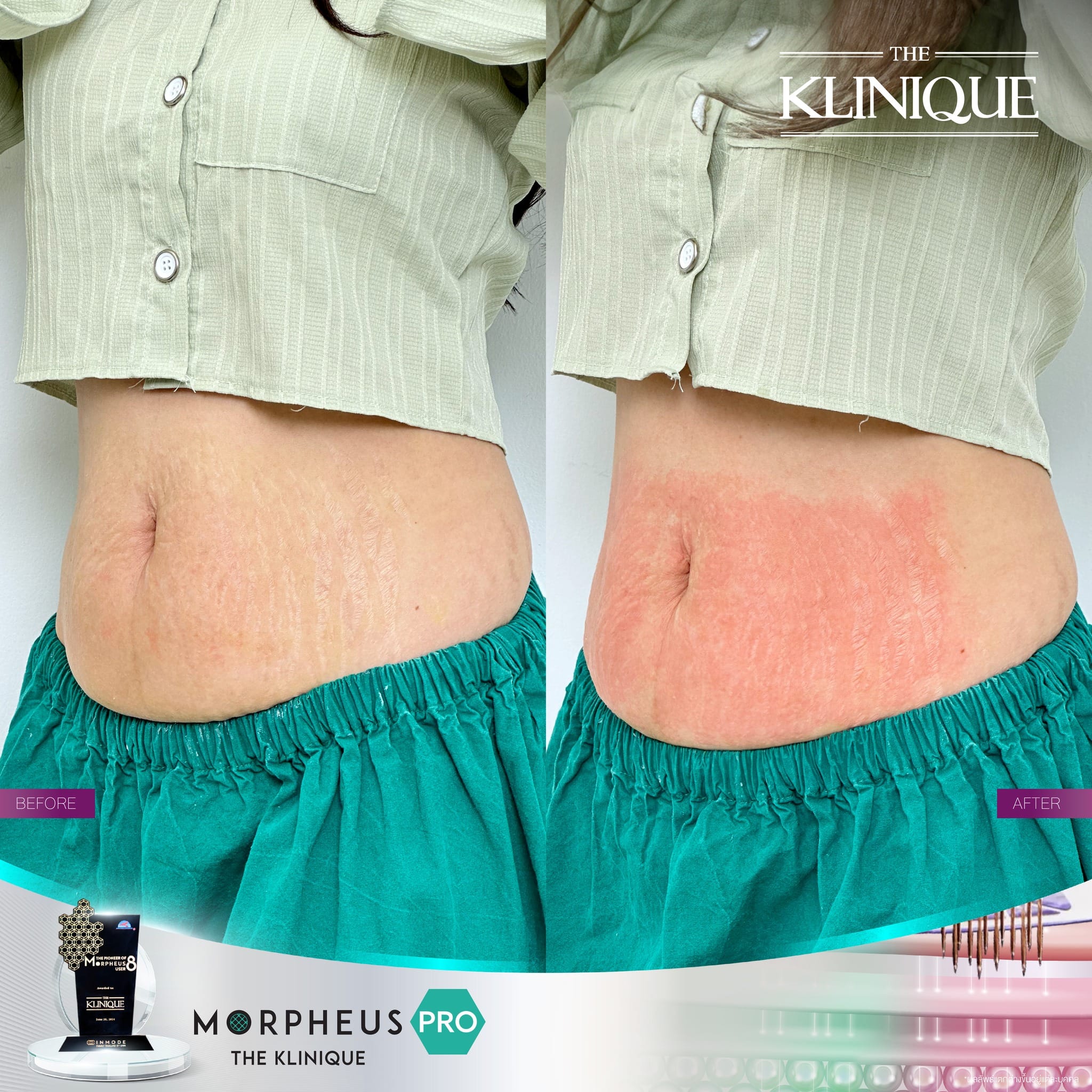 Morpheus PRO Body จบปัญหาผิวยับ กระชับหุ่นย้วย เคลียร์ผิวแตกลาย - theklinique