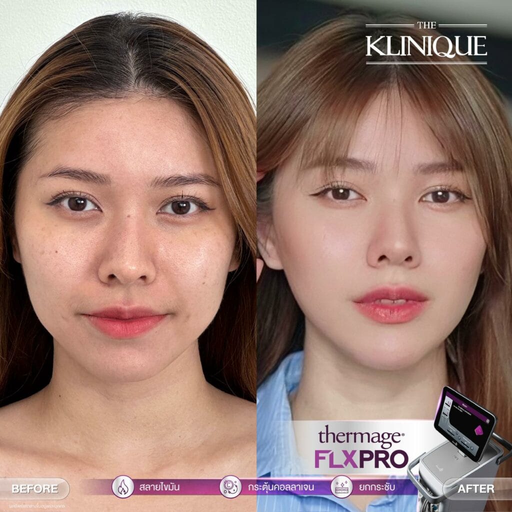 ทำไมต้องกระชับผิวด้วย Thermage FLX PRO นวัตกรรมหน้าเด็ก ผิวเฟิร์มฟู ...