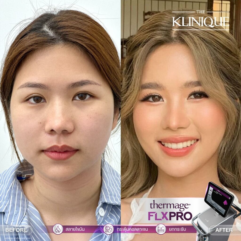 ทำไมต้องกระชับผิวด้วย Thermage FLX PRO นวัตกรรมหน้าเด็ก ผิวเฟิร์มฟู ...
