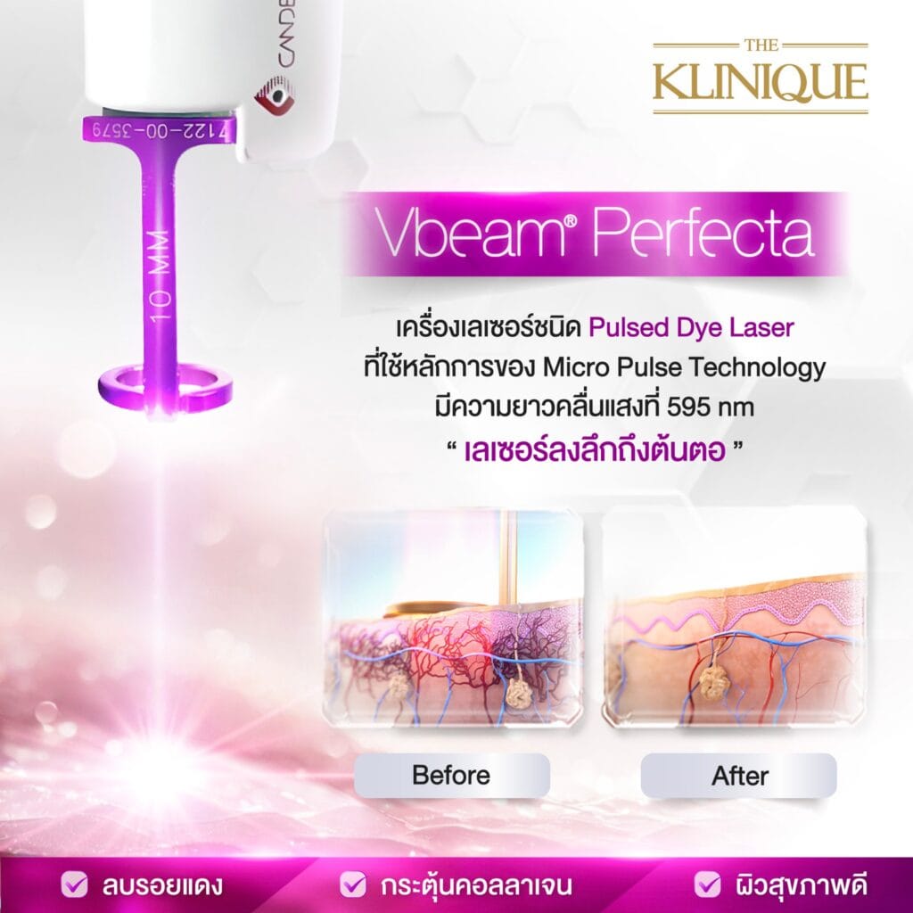 VBeam Laser รักษาปานแดงแต่กำเนิดได้จริงหรือ? - theklinique