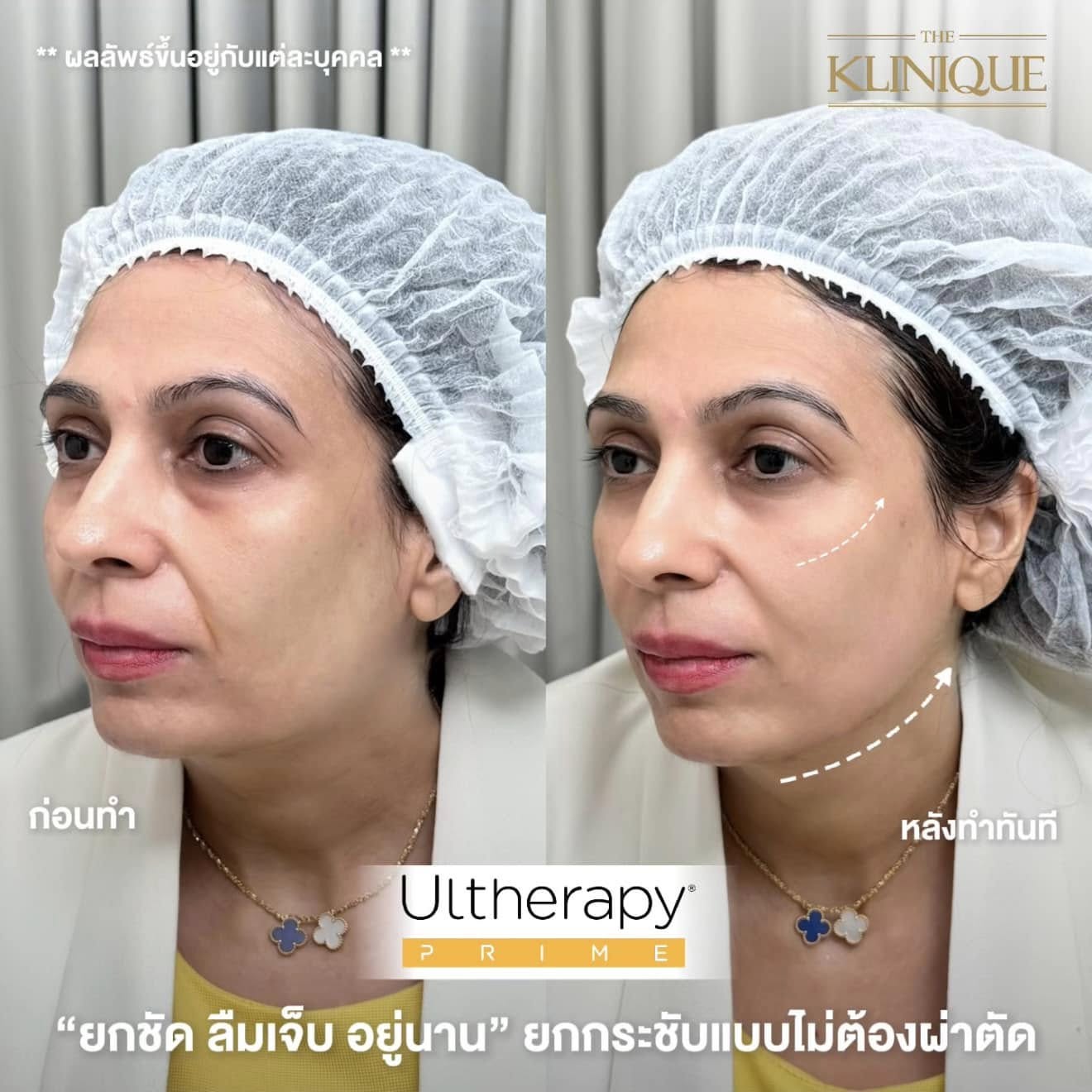 หมอสุนิล แซว Madam Pooja “คนไหนแม่…คนไหนลูก” หลังภรรยาซุ่มทำ Ultherapy ...