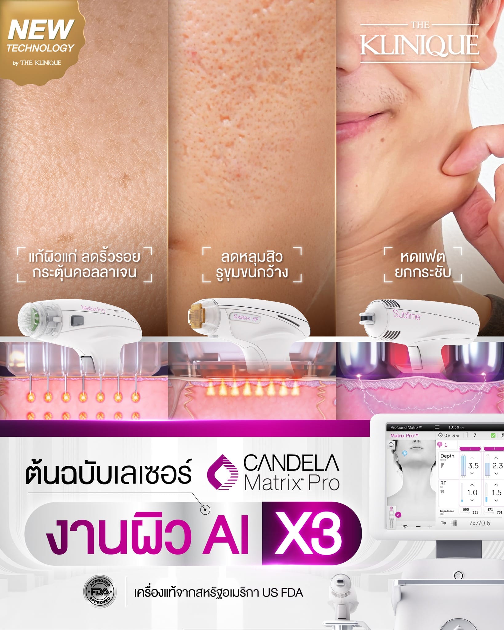 ติดฟิลเตอร์ผิวสวยด้วยโปรแกรม Candela Matrix PRO เลเซอร์งานผิว AI ...