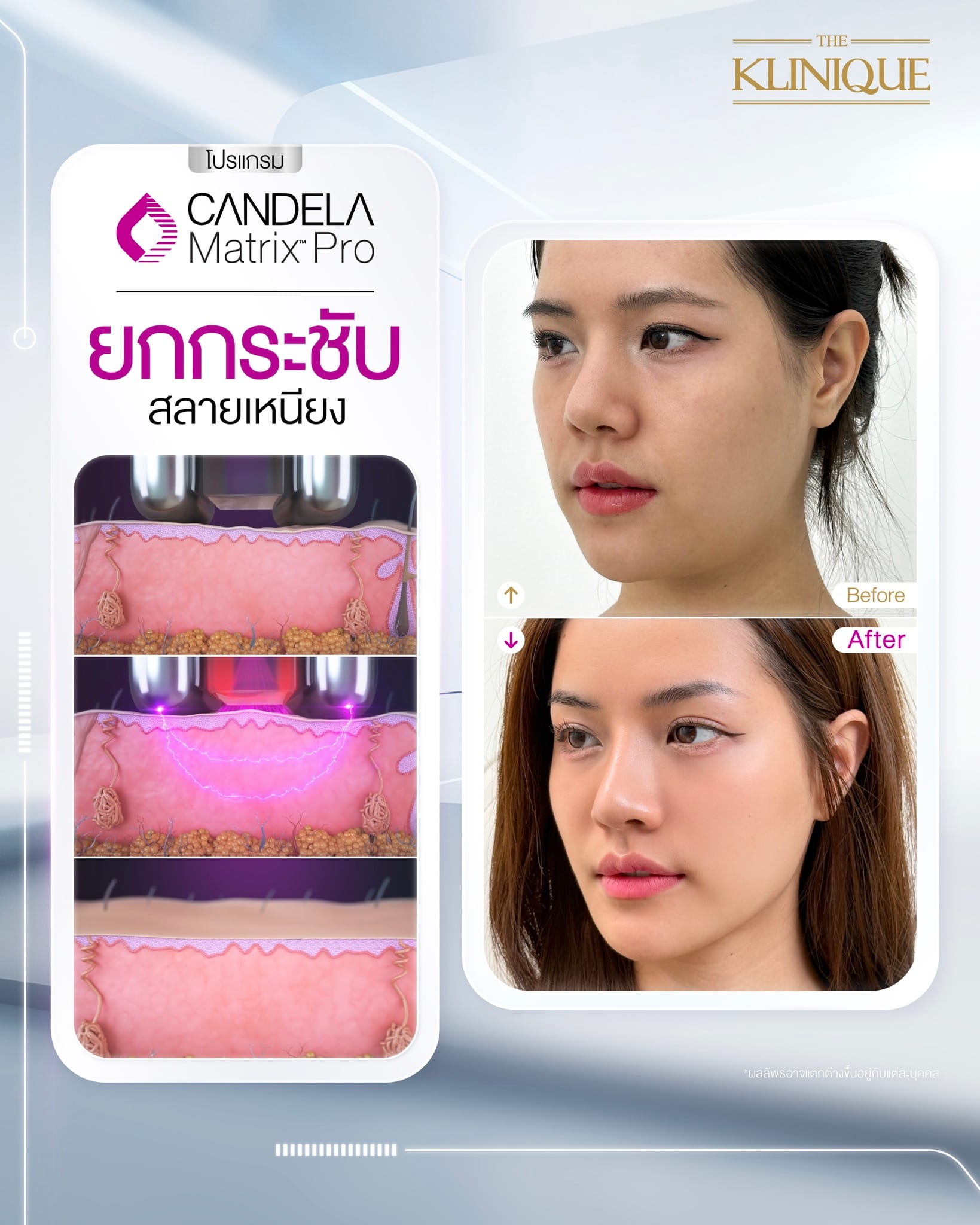 ติดฟิลเตอร์ผิวสวยด้วยโปรแกรม Candela Matrix PRO เลเซอร์งานผิว AI ...
