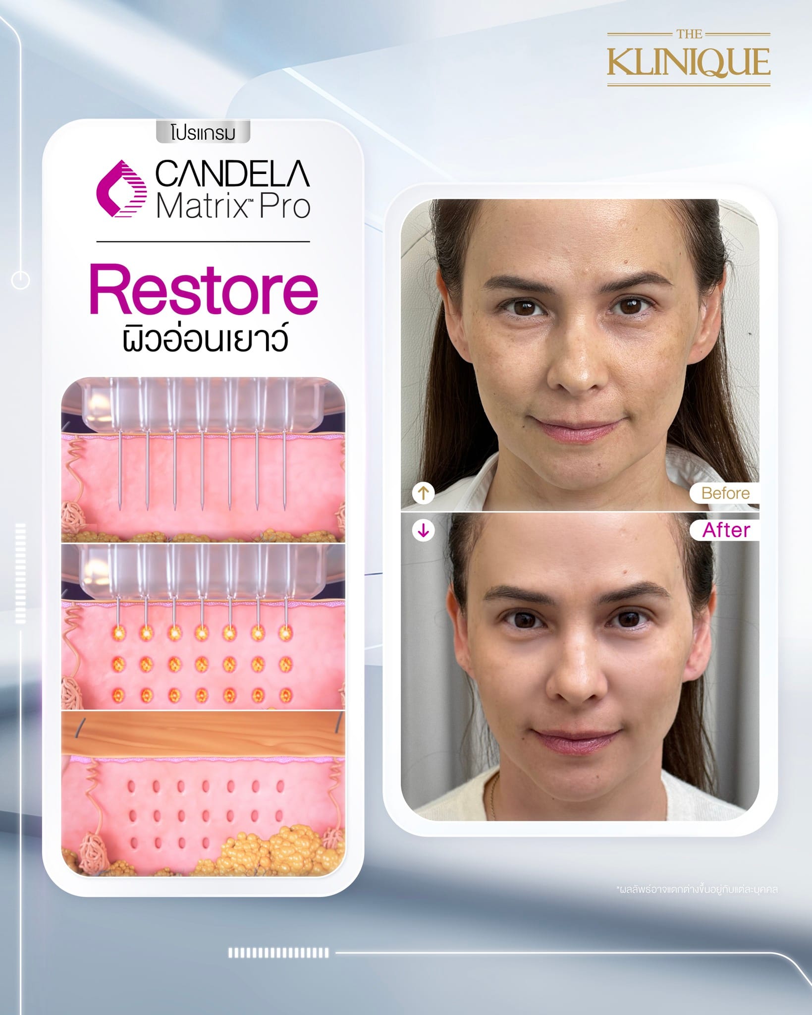 ติดฟิลเตอร์ผิวสวยด้วยโปรแกรม Candela Matrix PRO เลเซอร์งานผิว AI ...