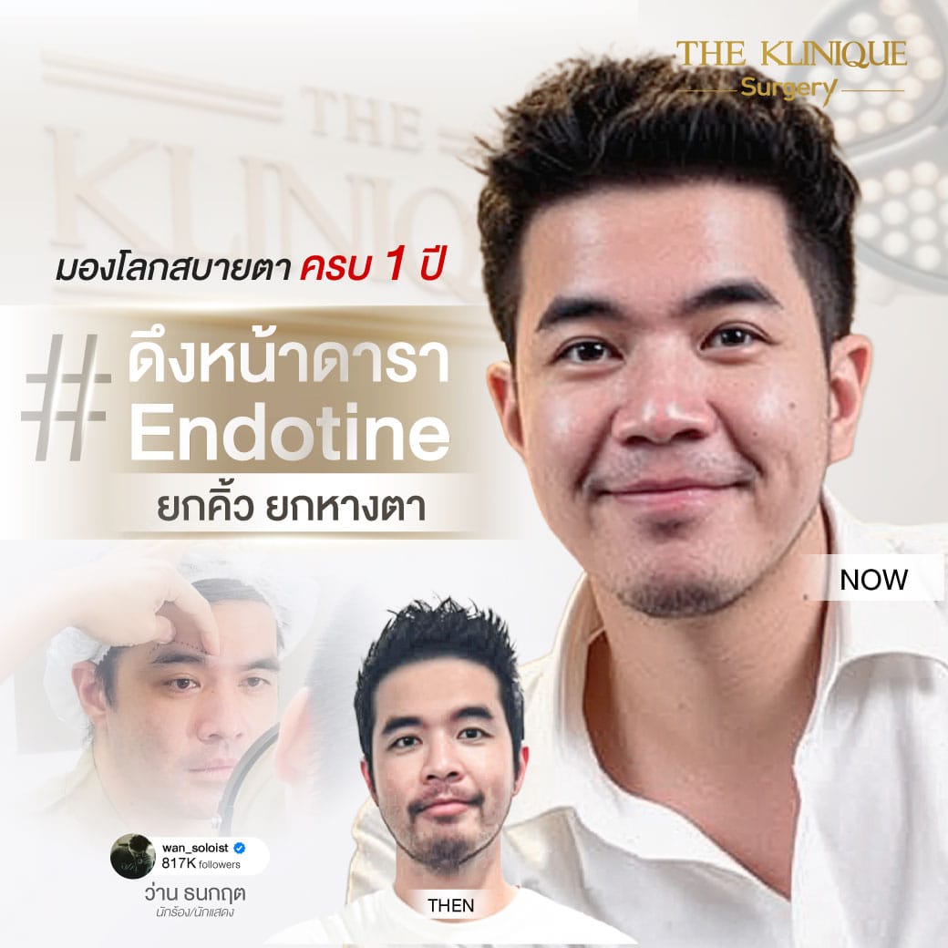 ว่าน ธนกฤต ดึงหน้าEndotine ยกหางตา ยกคิ้ว ครบ 1 ปี สดใสกว่าที่เคย